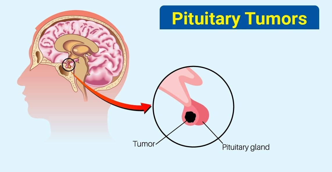 Pituitary Tumor Symptoms Pituitary Tumor Symptoms